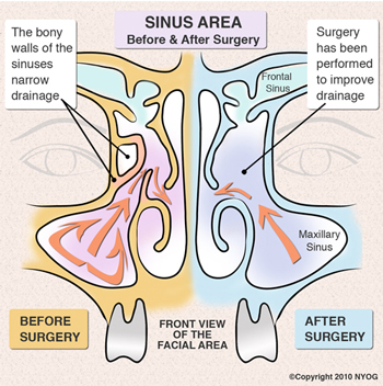 Endoscopic Sinus Surgery: Ancient Technique, Modern Science